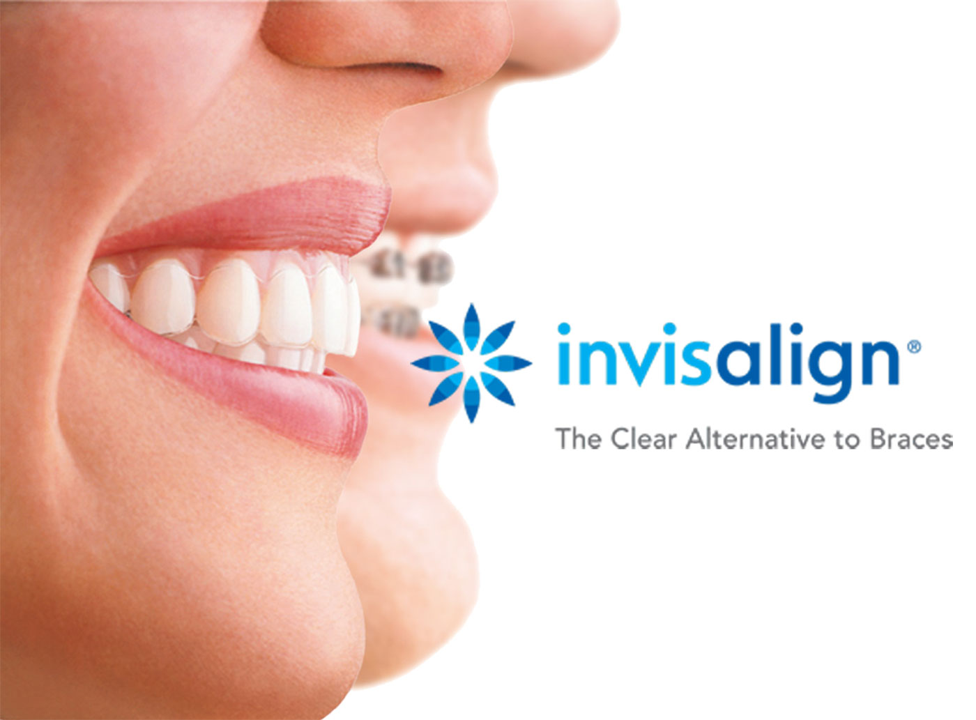 Invisalign Balneário Camboriú - As 63 Perguntas - Dr. Francisco Stroparo